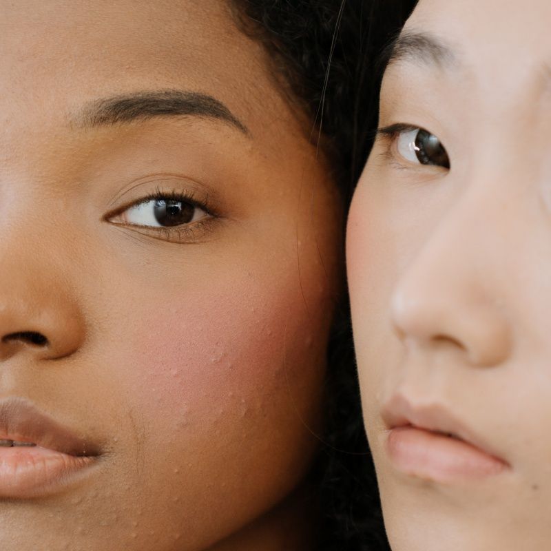 Skincare 101: The Best Acne Treatments to Zap Zits Effectively